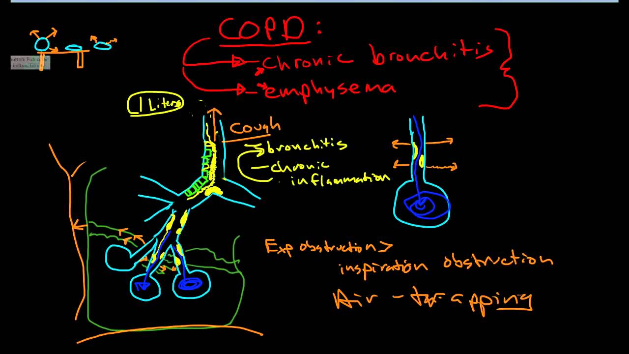 Sealereefv Copd Pathophysiology Powerpoint